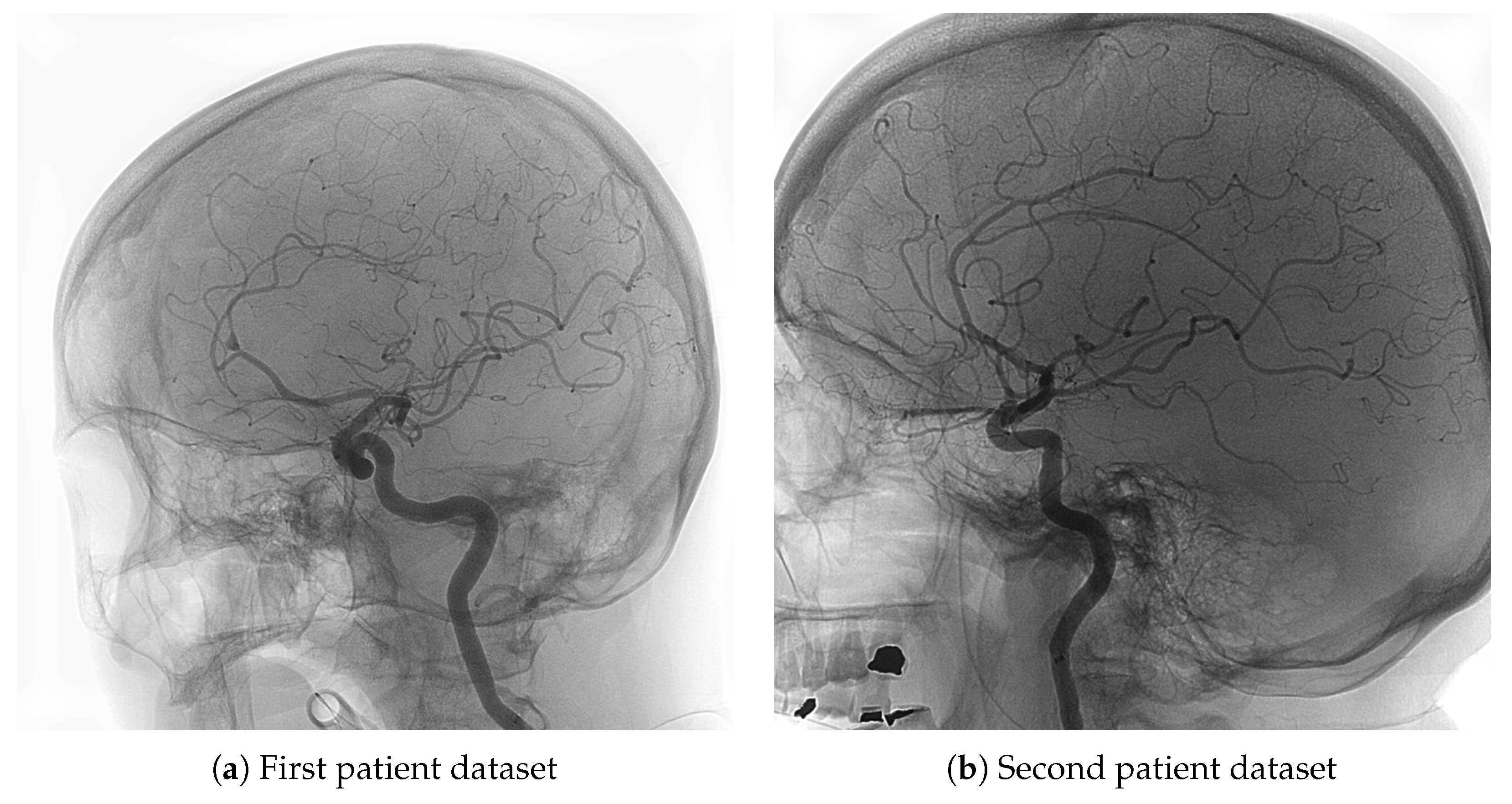Neural Vessel Segmentation and Gaussian Splatting for 3D Reconstruction ...