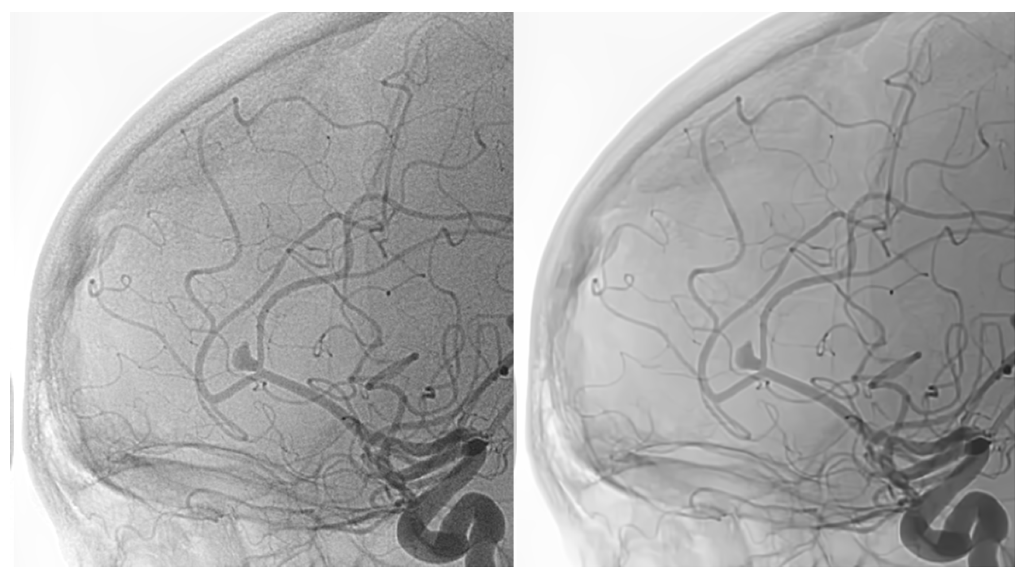 Neural Vessel Segmentation and Gaussian Splatting for 3D Reconstruction ...
