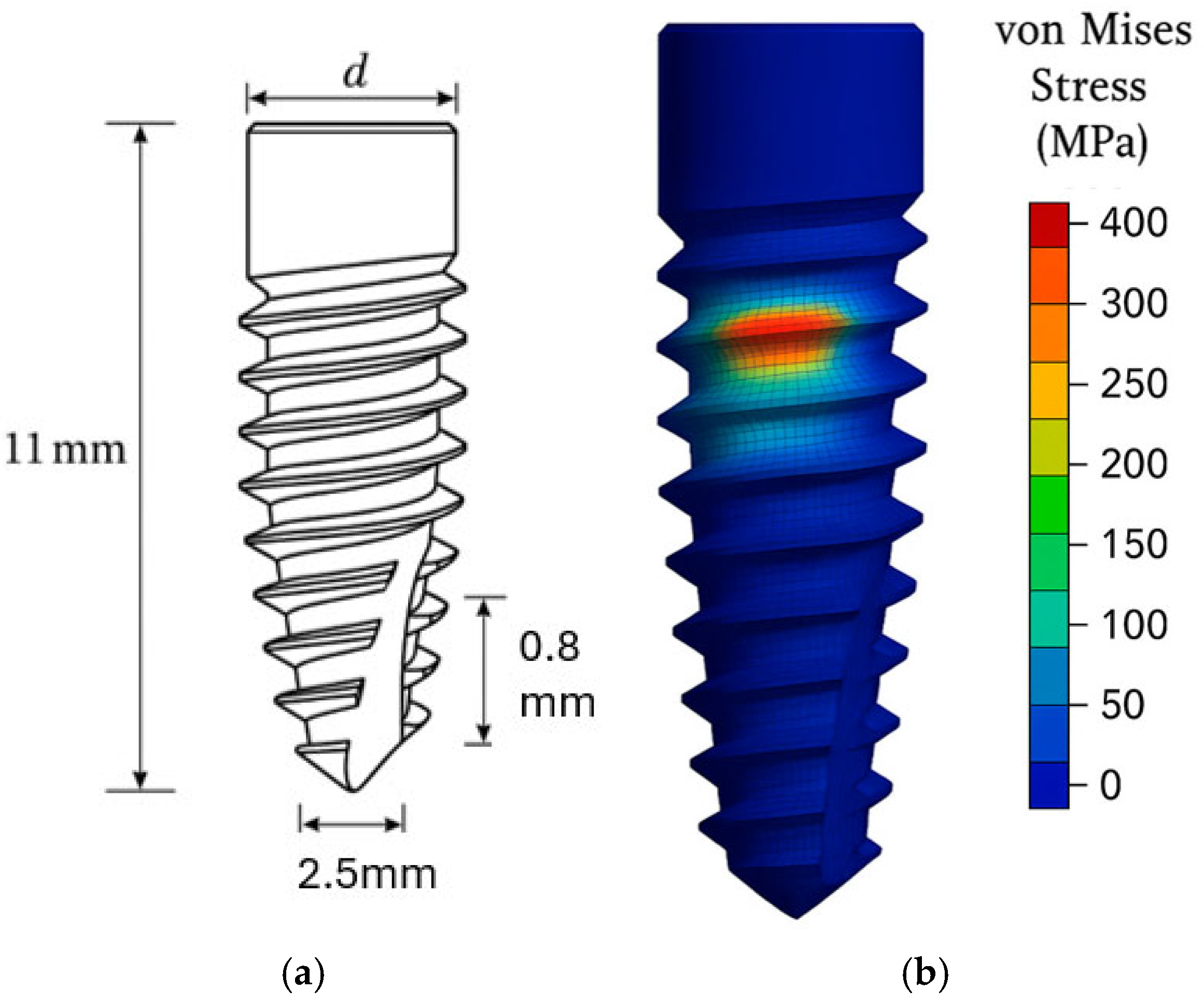Predicting Critical Failure Zones in Dental Implants: A Comparison of ...