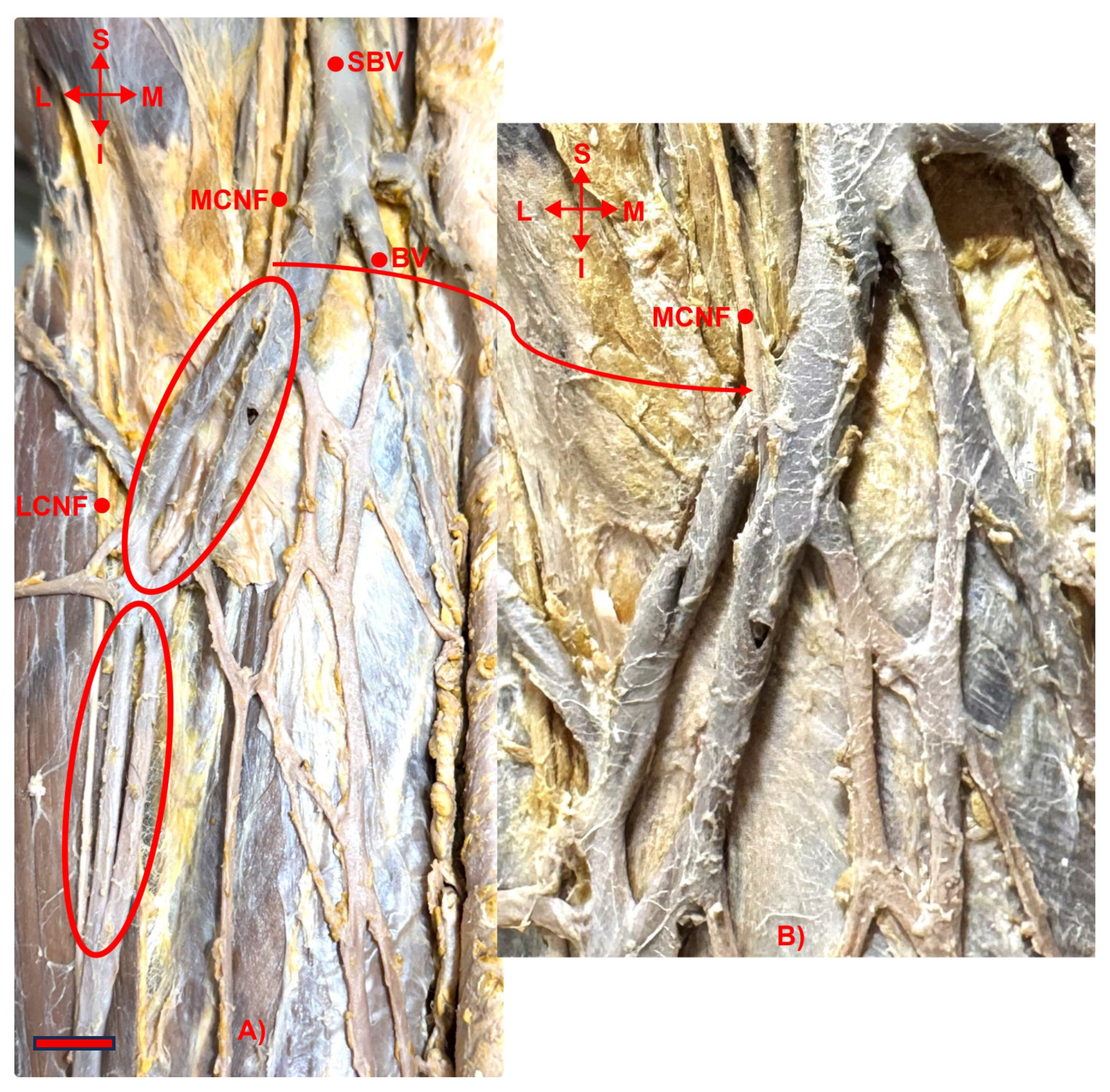 Dual Origin of the Cephalic Vein with Double Fenestration: A Case Report