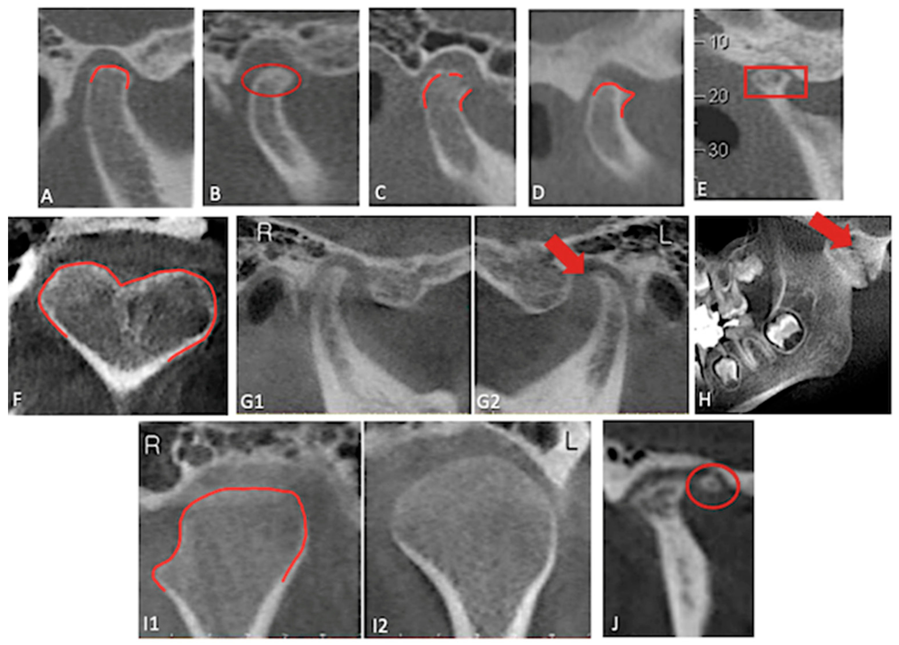 Osseous Changes and Morphometric Measurements in the Temporomandibular ...