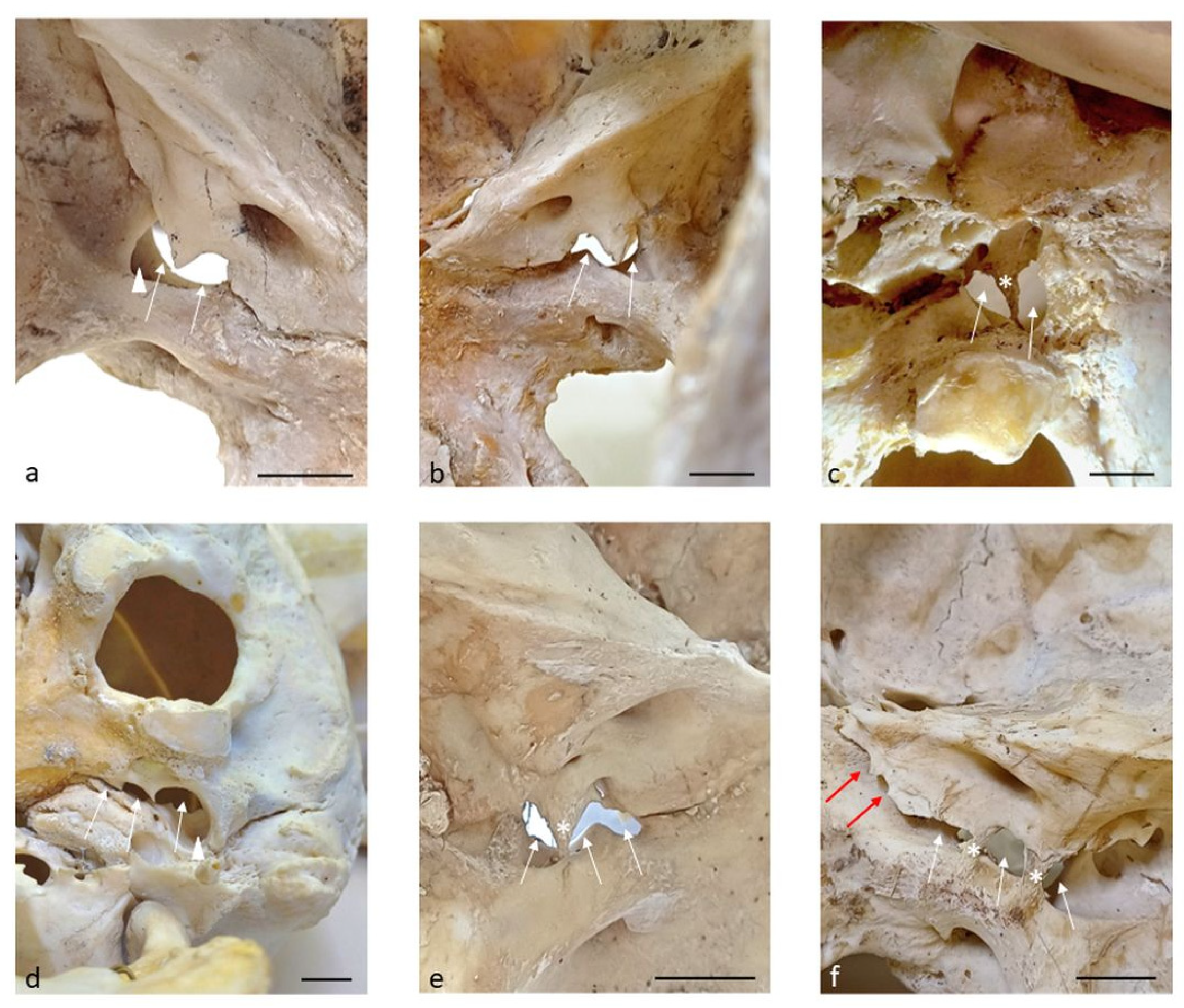 Osteological Compartmentalization Model of Jugular Foramina Compared ...