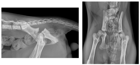 A Bilateral Acetabular Physeal Fracture Treated with External Fixation ...