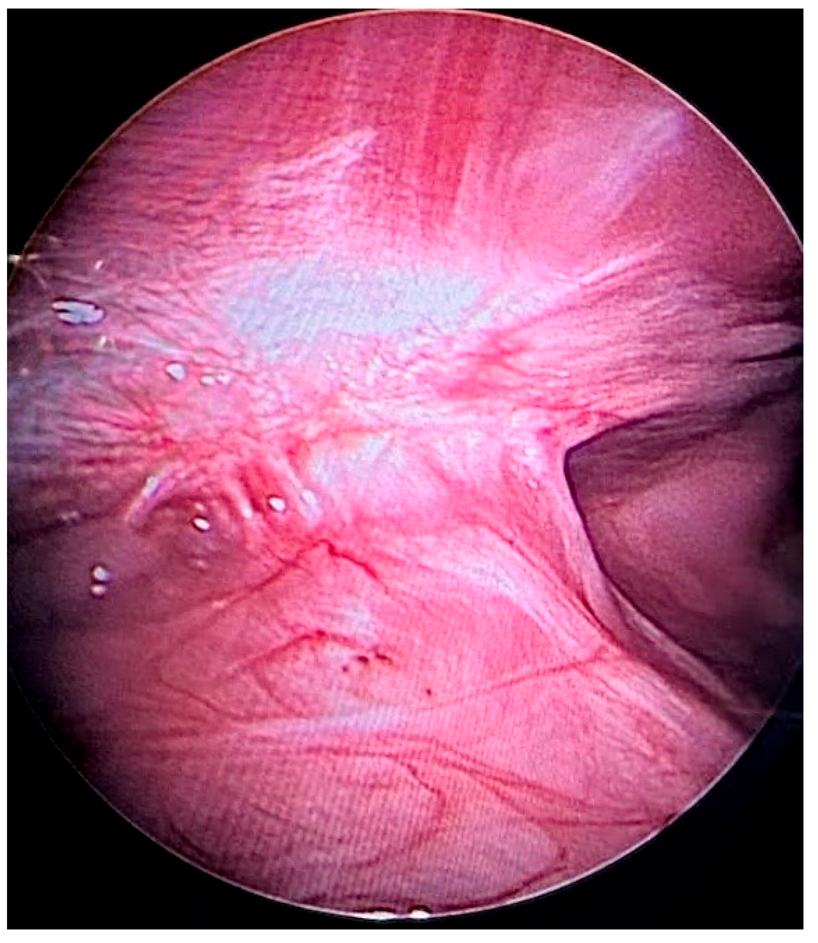 Combination of Laparoscopic Sutureless Gastropexy and Ovariectomy in Dogs