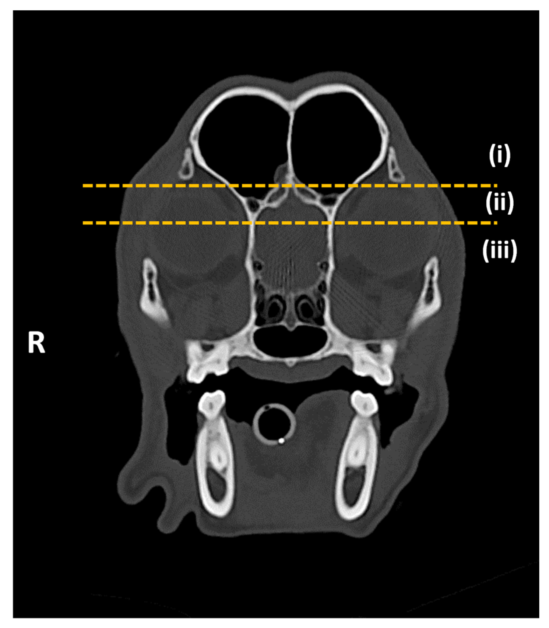 Computed Tomographic Features and Prevalence of Orbital Ligament ...