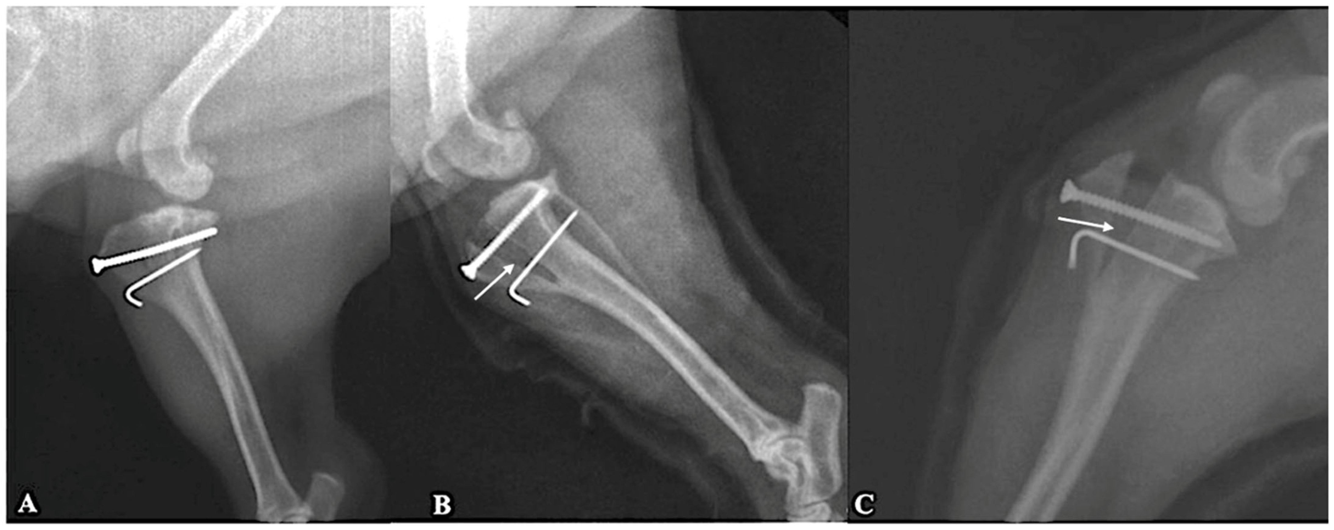 Retrospective Clinical and Radiographic Outcomes of a Cageless Tibial ...