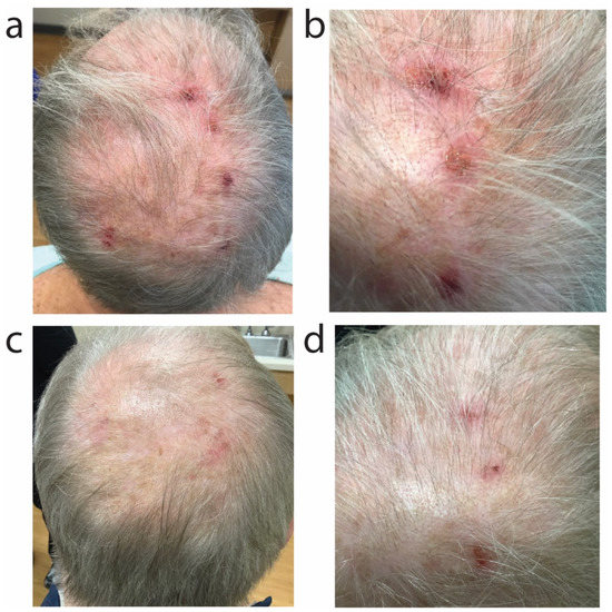 Antibiotics | Special Issue : Antibiotic Treatment in Dermatology