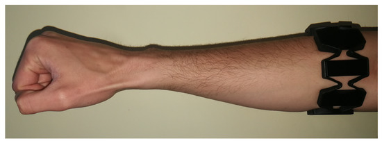 Donning/Doffing and Arm Positioning Influence in Upper Limb Adaptive ...