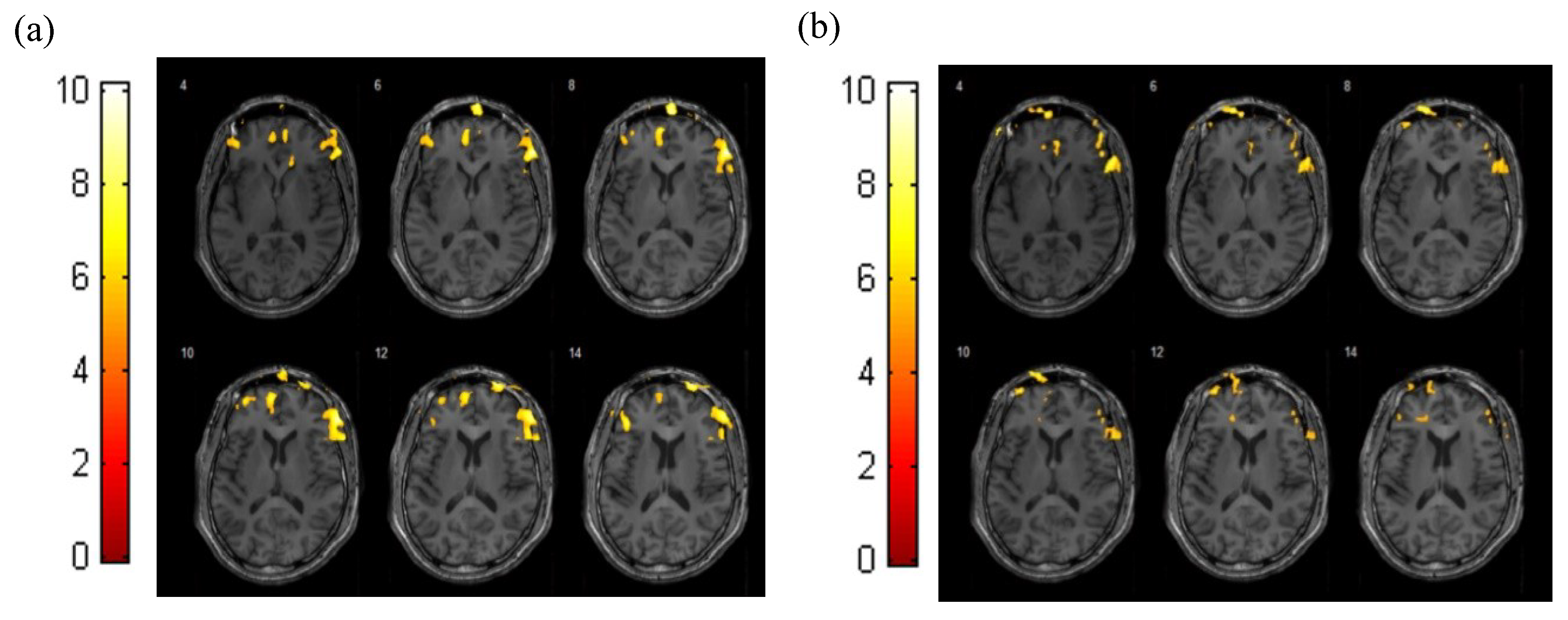 Diffuse Optical Tomography Using Bayesian Filtering in the Human Brain