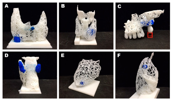 Mesh-Type Three-Dimensional (3D) Printing of Human Organs and Tumors ...