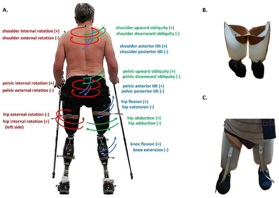 Using Stubby Prosthesis after Bilateral Transfemoral Amputation: A Biomechanical Case Study