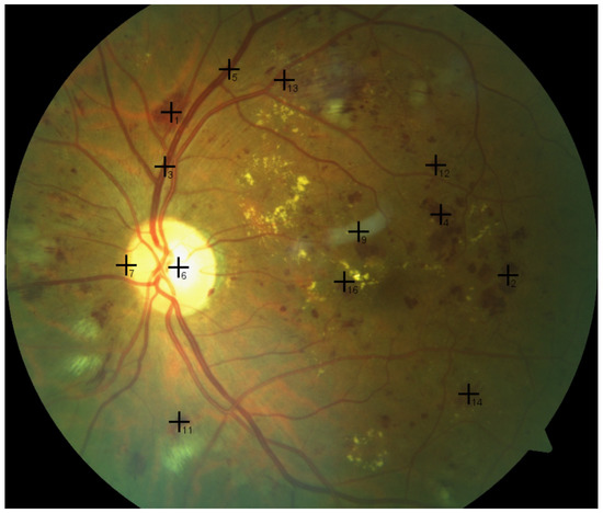 Accurate Diagnosis of Diabetic Retinopathy and Glaucoma Using Retinal ...