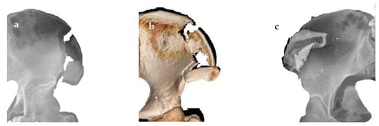 Risk Factors of Avulsion Fracture after Iliac Crestal Flap for Jaw ...