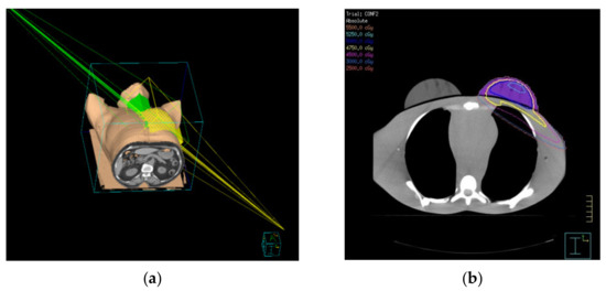 A Dosimetric Analysis of Reduction Cardiac Dose with Lead Shielding in ...