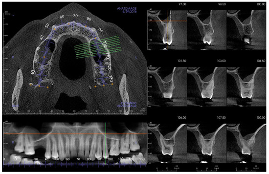 Applied Sciences | Free Full-Text | Maxillary Sinusitis of Odontogenic ...