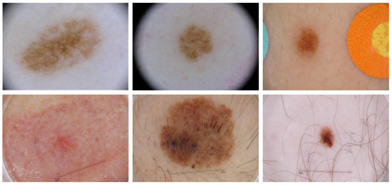 An Improved Multi-Scale Feature Fusion for Skin Lesion Segmentation