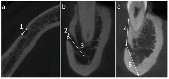 Anatomy of the Mental Foramen: Relationship among Different Metrical ...