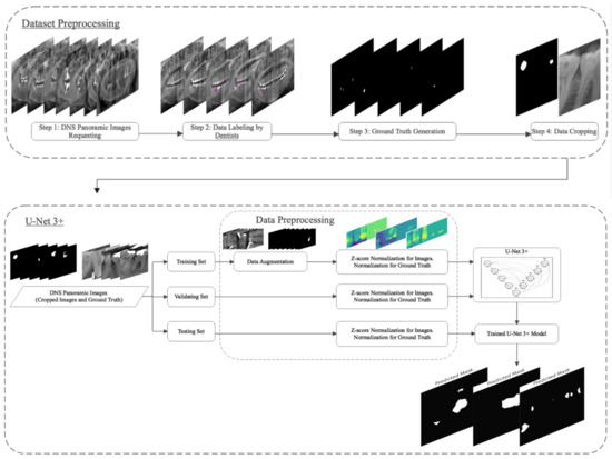 Detection of Cavities from Dental Panoramic X-ray Images Using Nested U ...