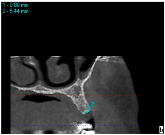 Evaluation of Alveolar Bones in the Context of Orthodontic Single-Tooth ...