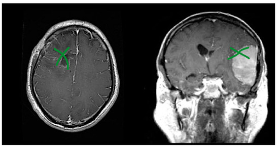 Applied Sciences | Free Full-Text | Brain Tumor Detection with Deep ...