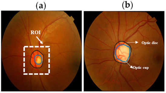 Optic Disc Segmentation in Human Retina Images Using a Meta Heuristic ...