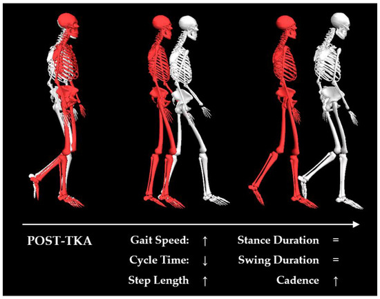 Analysis of Spatiotemporal Gait Variables before and after Unilateral ...