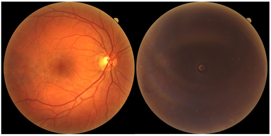 Myopia Detection from Eye Fundus Images: New Screening Method Based on ...