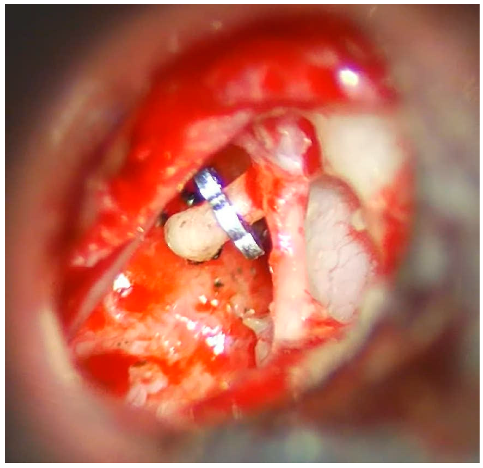 Comparison Between Titanium and Thermally Activated Prostheses in ...