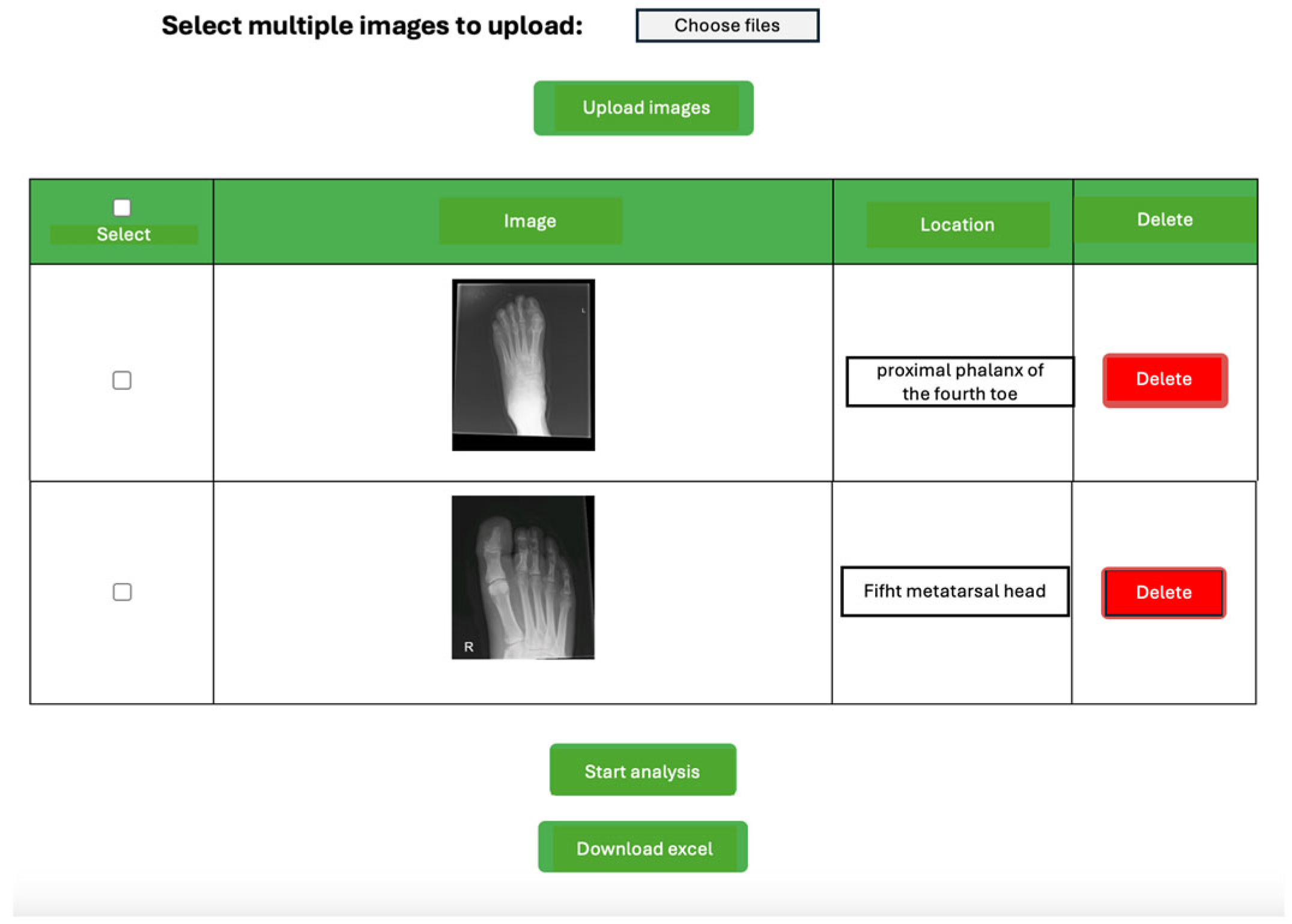 Using Artificial Intelligence for Detecting Diabetic Foot Osteomyelitis: Validation of Deep ...
