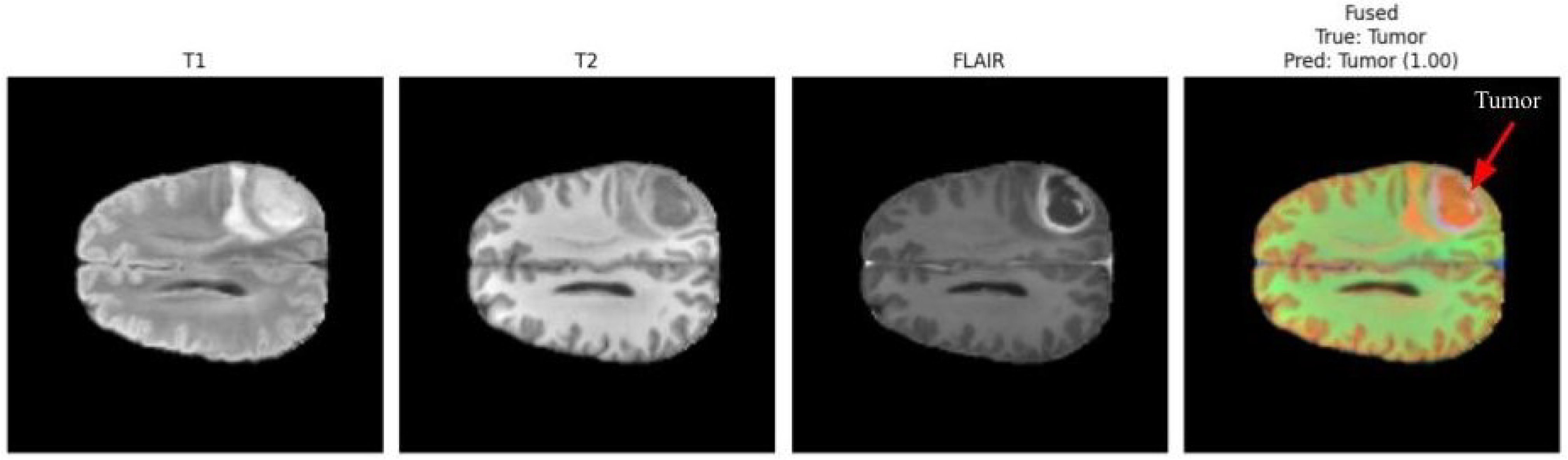 Deep Learning-Based Fusion of Multimodal MRI Features for Brain Tumor ...