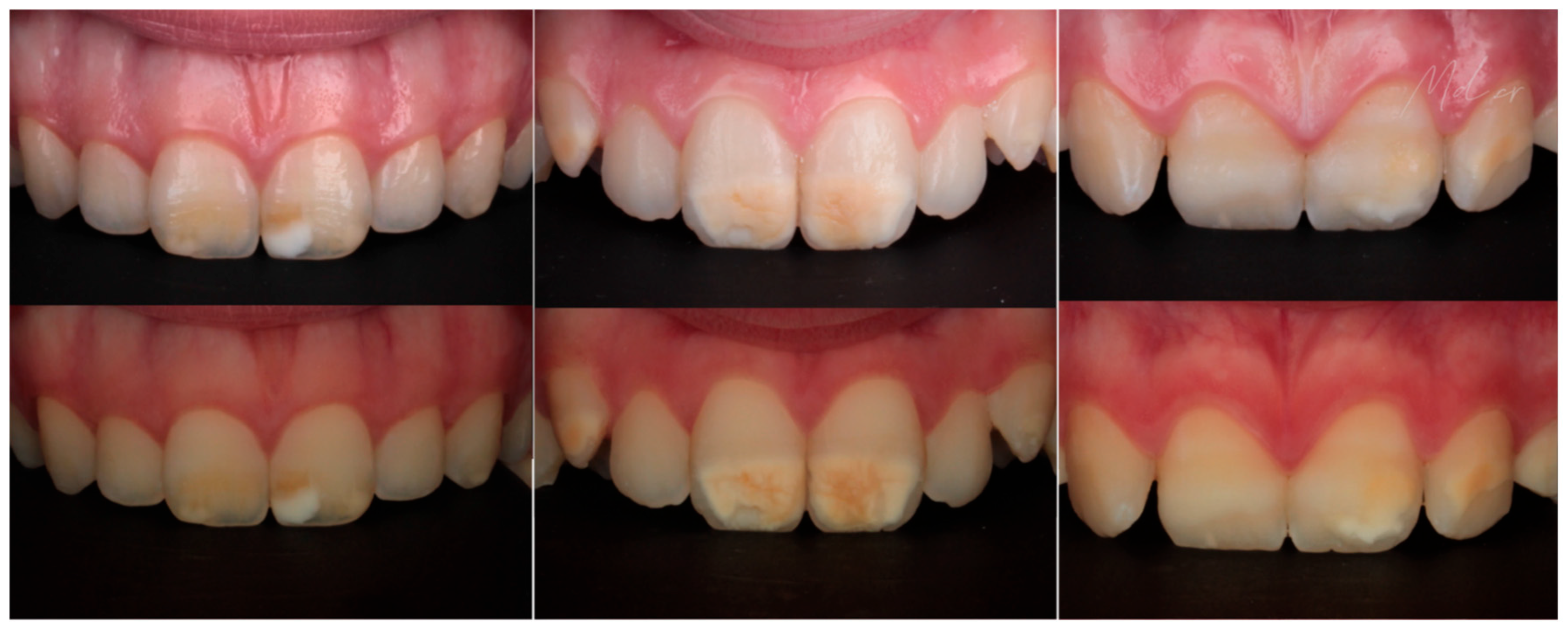 Resin Infiltration for Management of Anterior Teeth with Molar Incisor ...