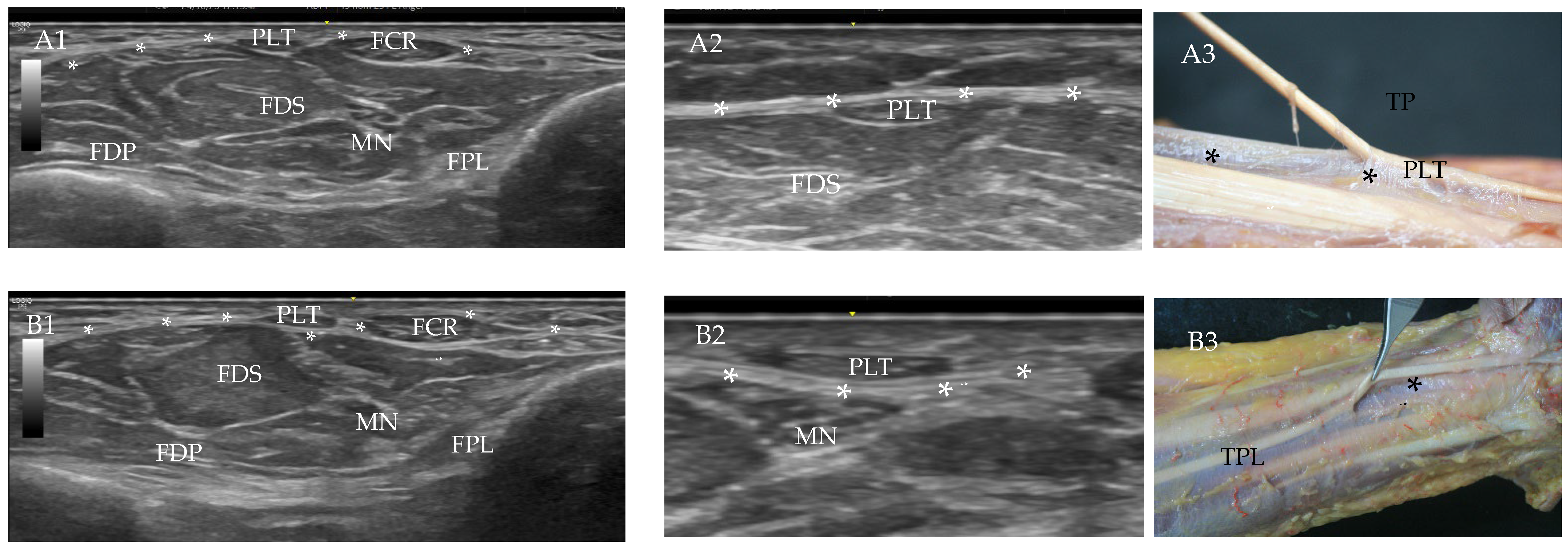 Palmaris Longus Muscle and Its Variations: Ultrasound, Anatomical and ...
