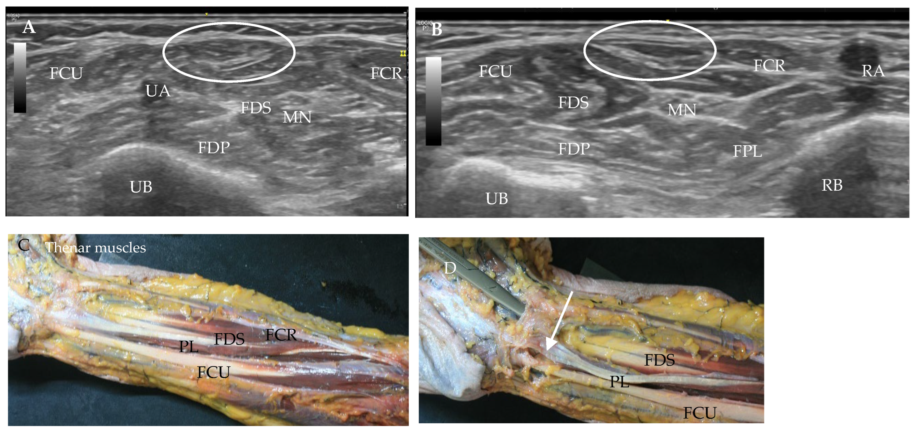 Palmaris Longus Muscle and Its Variations: Ultrasound, Anatomical and ...