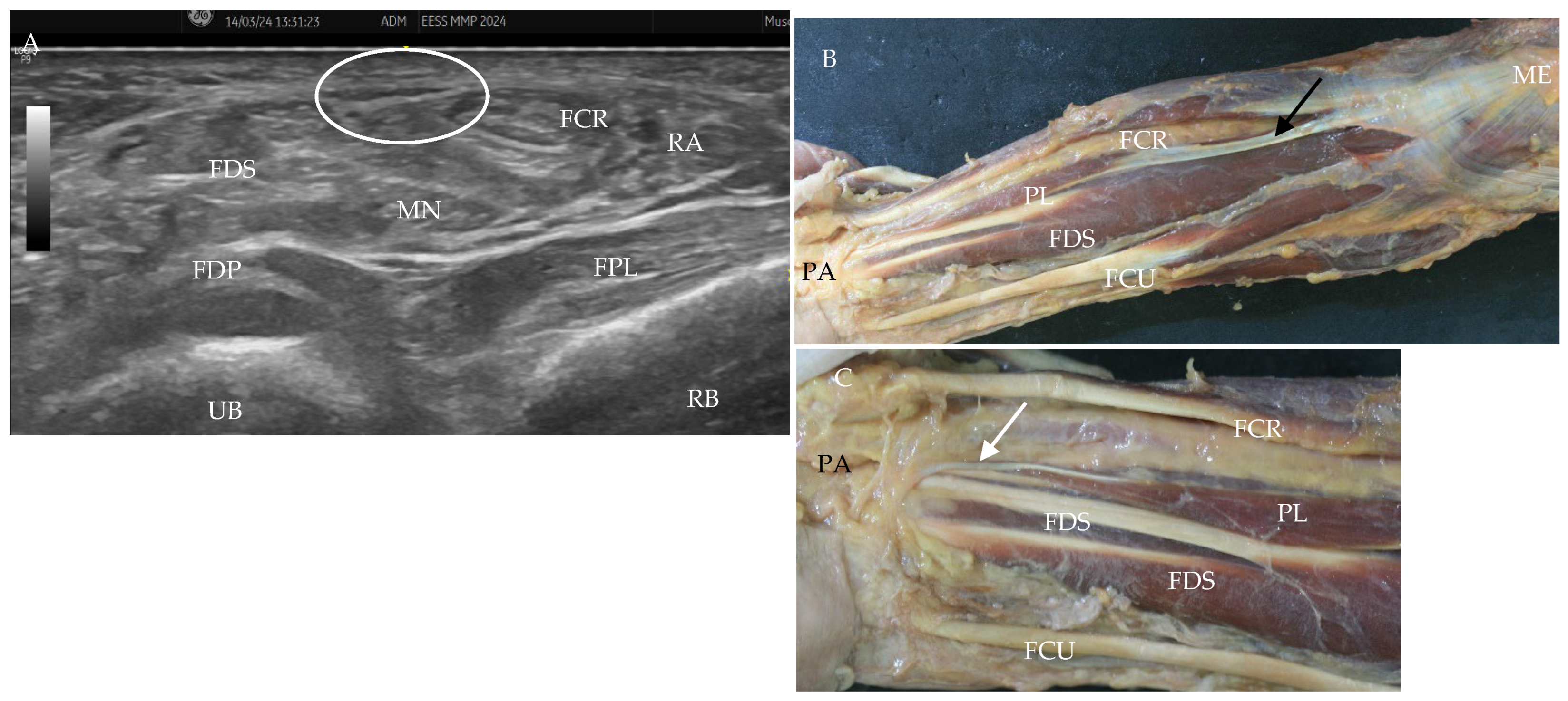 Palmaris Longus Muscle and Its Variations: Ultrasound, Anatomical and ...