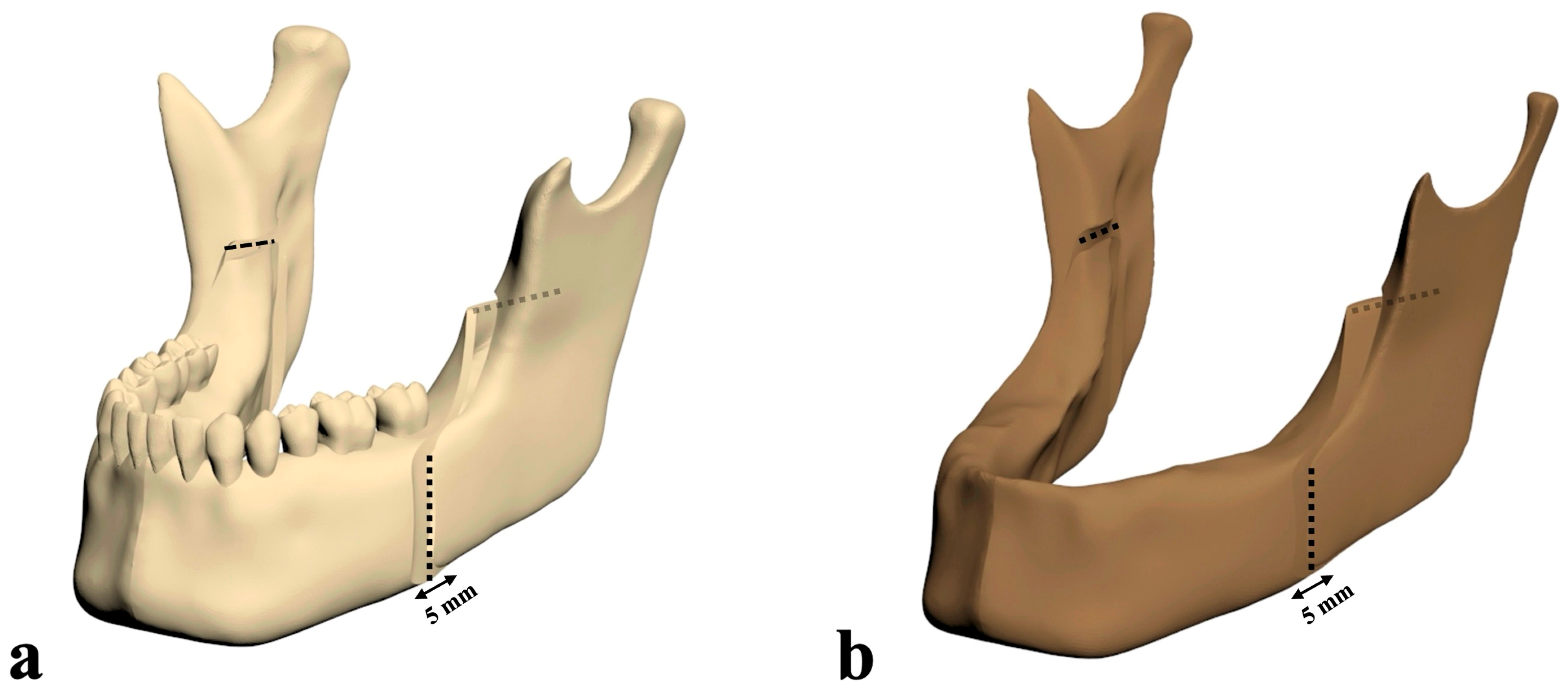 Finite Element Analysis of Different Fixation Configurations After ...