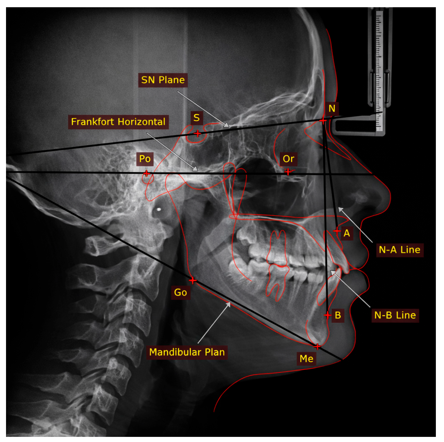 Three-Dimensional Quantitative Analysis of Maxillary Arch Morphology ...