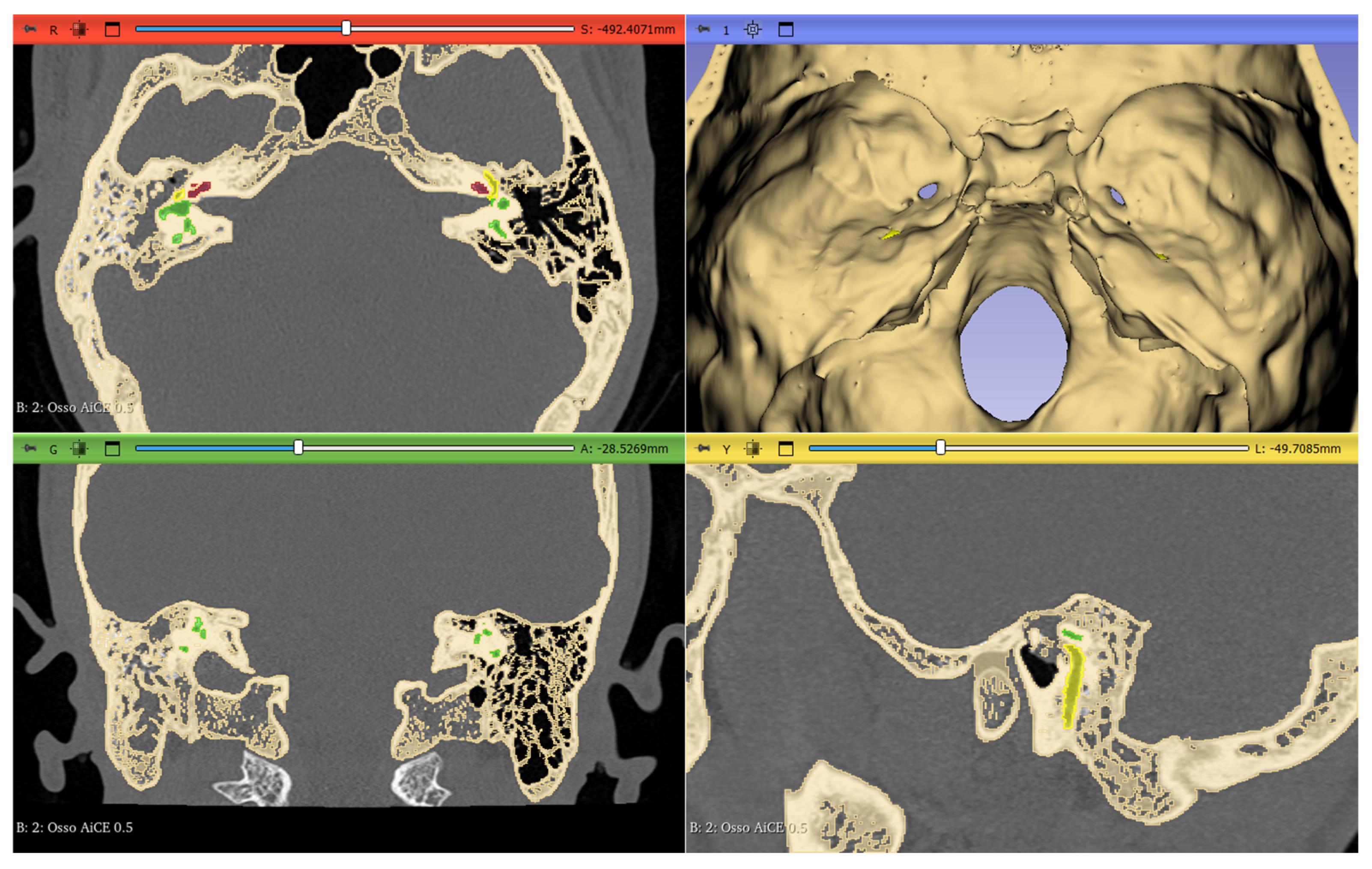 Pathology-Oriented 3D-Printed Temporal Bone Models for Cholesteatoma ...