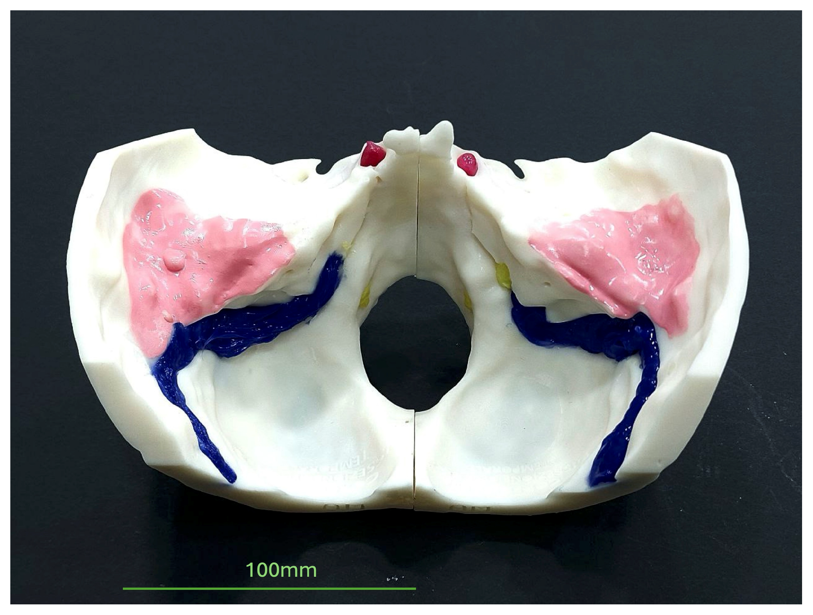 Pathology-Oriented 3D-Printed Temporal Bone Models for Cholesteatoma ...