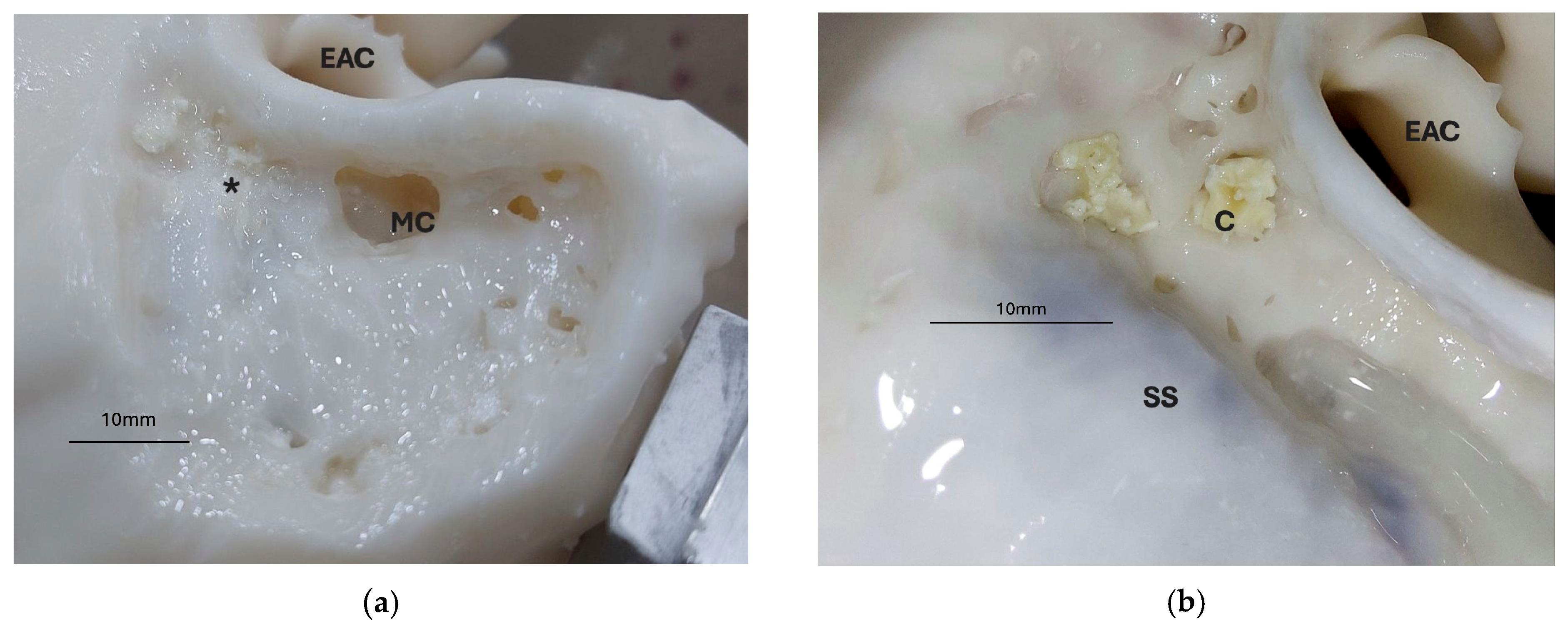 Pathology-Oriented 3D-Printed Temporal Bone Models for Cholesteatoma ...