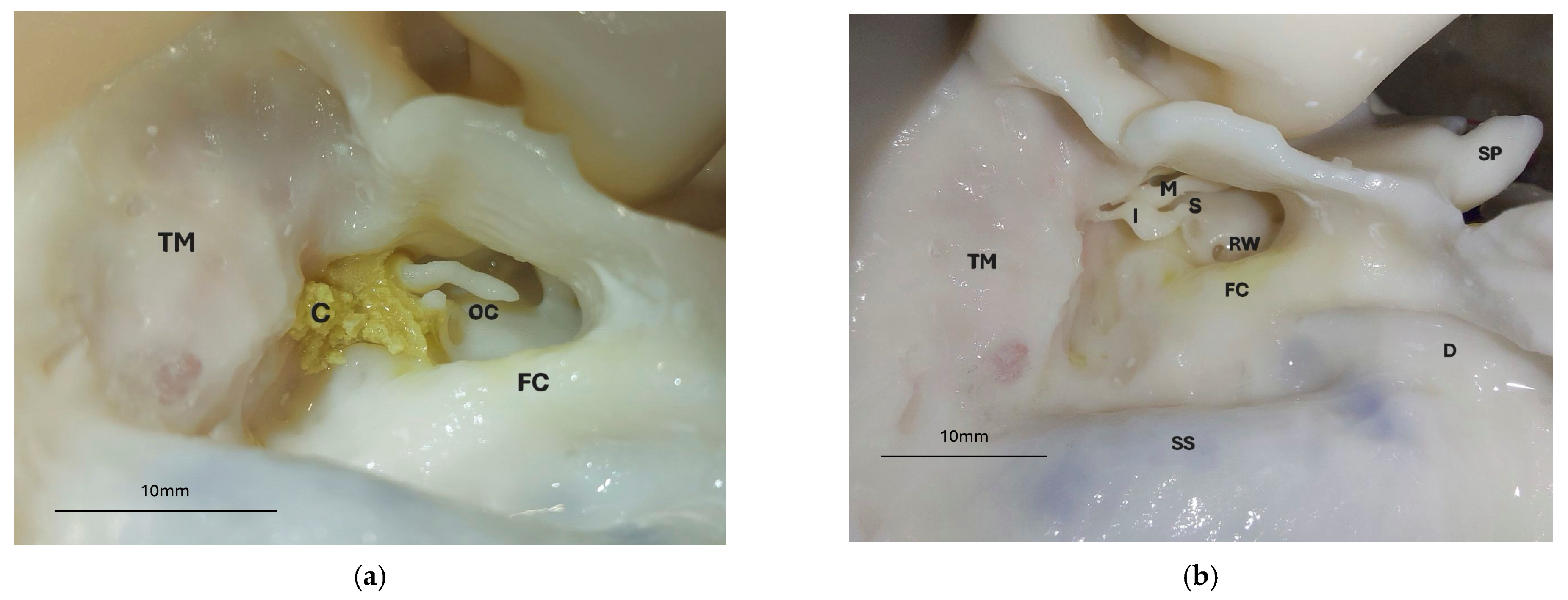 Pathology-Oriented 3D-Printed Temporal Bone Models for Cholesteatoma ...