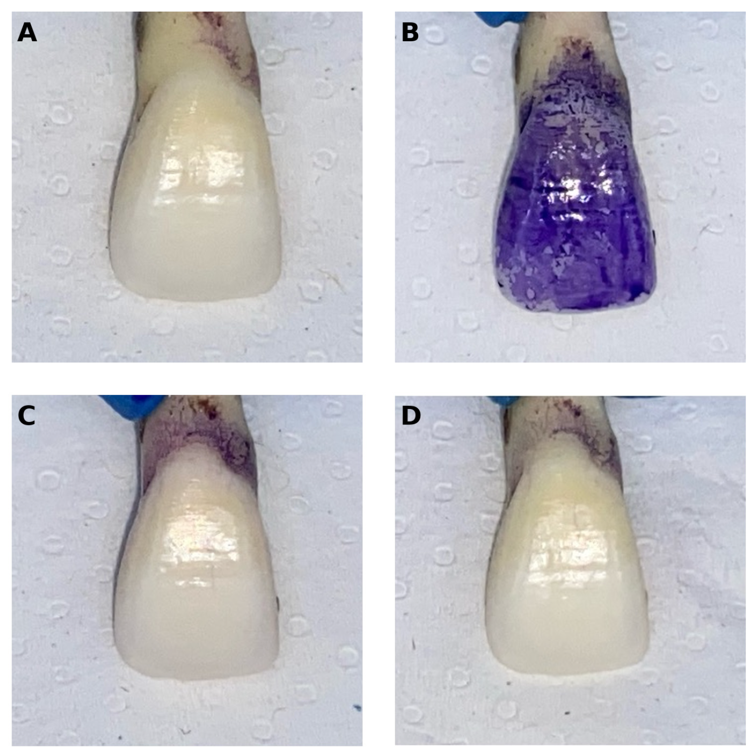 Alterations in Dental Enamel Color and Surface Characteristics ...
