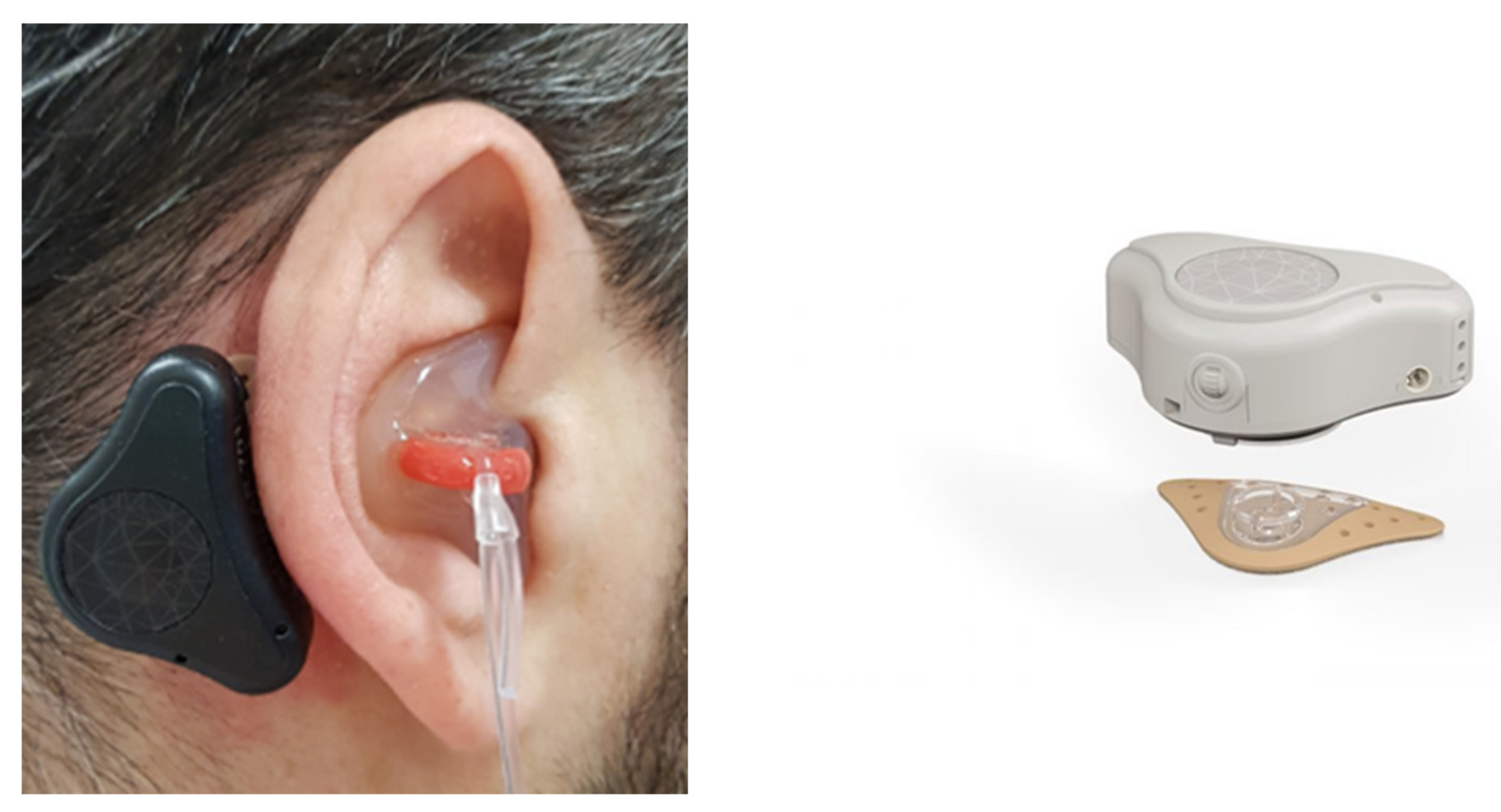 Audiology Research Free Full Text Audiological Performance Of Audiology Research Free Full Text Audiological Performance Of