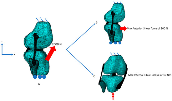 Predicting the Effect of Localized ACL Damage on Neighbor Ligament ...