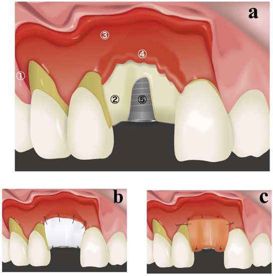 Resorbable Membrane Pouch Technique for Single-Implant Placement in the ...
