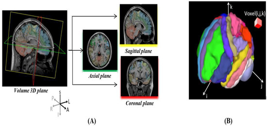 Multimodal Stereotactic Brain Tumor Segmentation Using 3D-Znet
