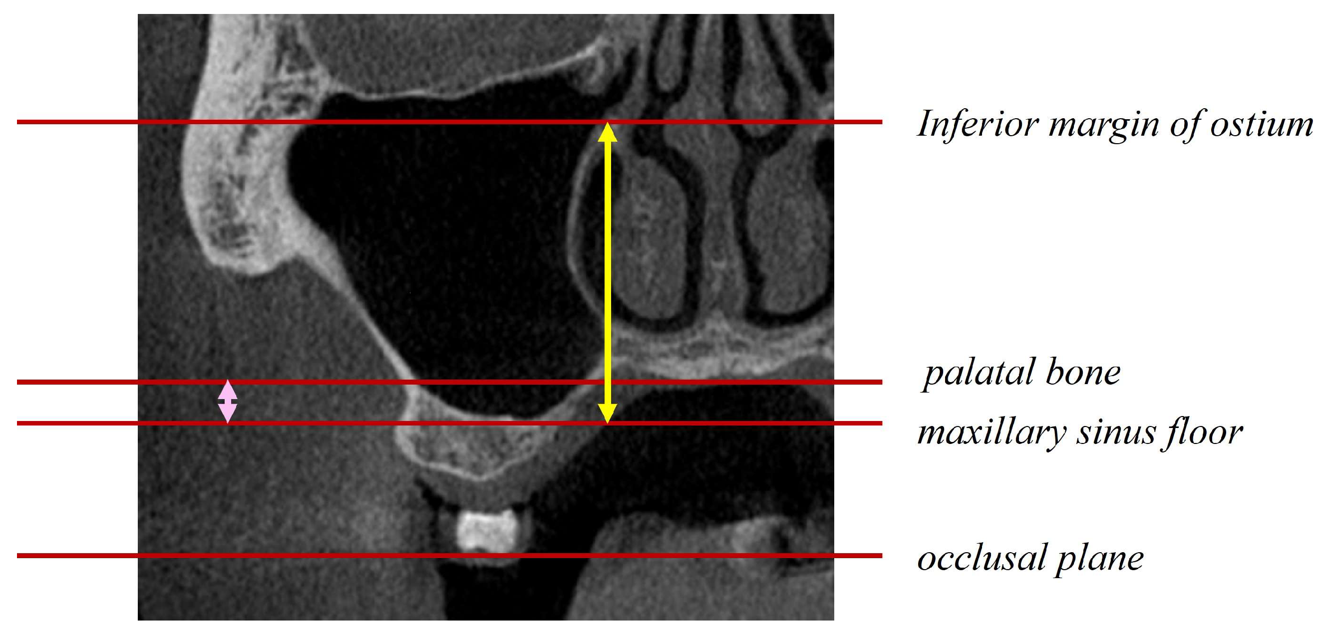 The Effectiveness and Practicality of a Novel Barrier Membrane for the ...