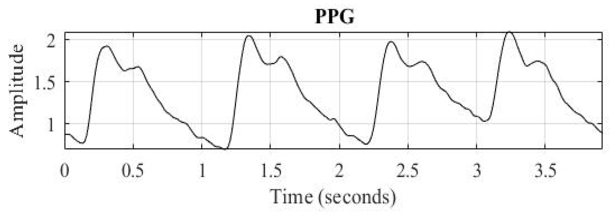 A Study on Evaluating Cardiovascular Diseases Using PPG Signals