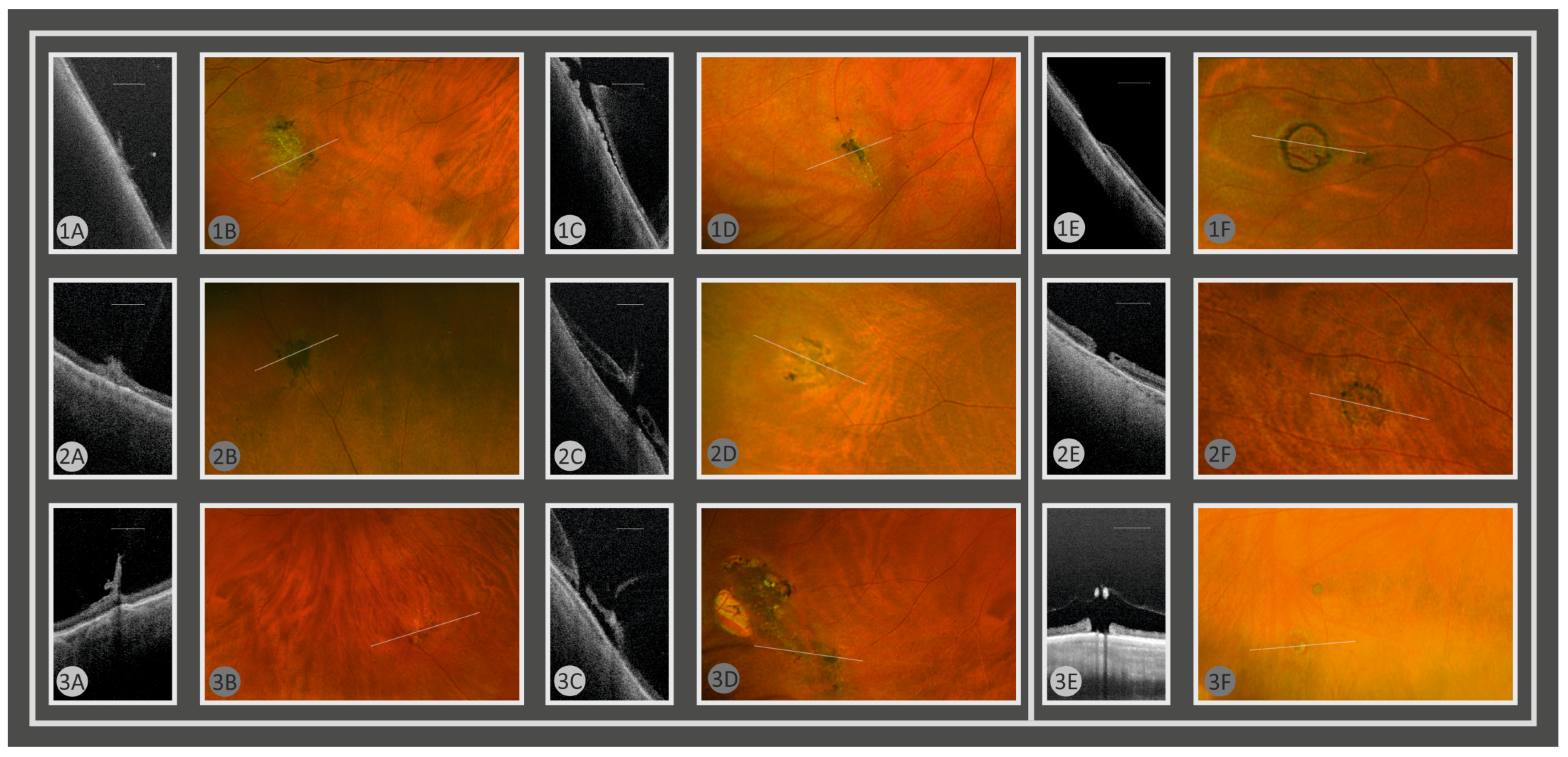Clinical Utility of Ultra-Widefield Fundus Photography with SS-OCT ...