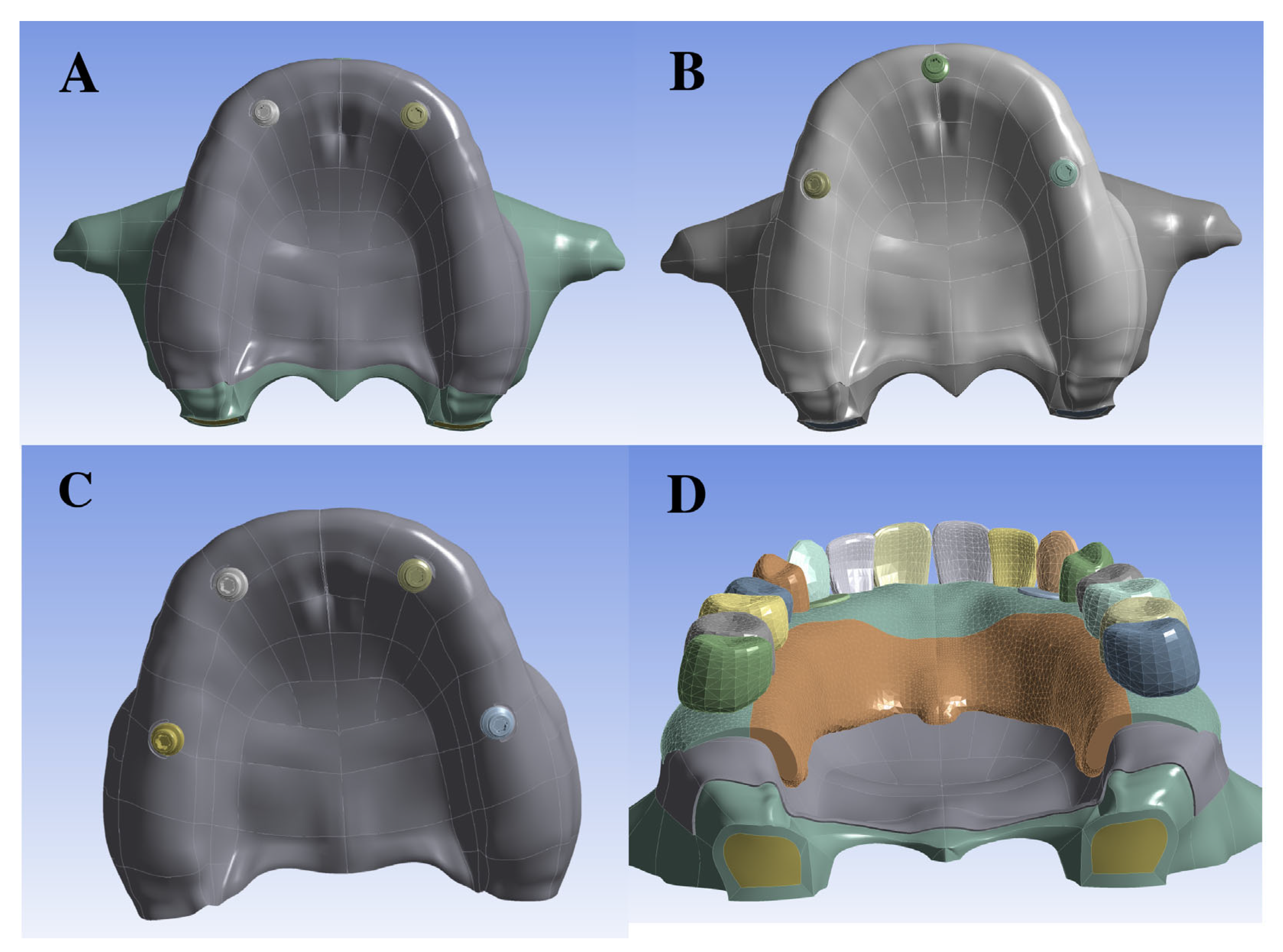 Finite Element Analysis of Maxillary Overdentures Supported by Two ...
