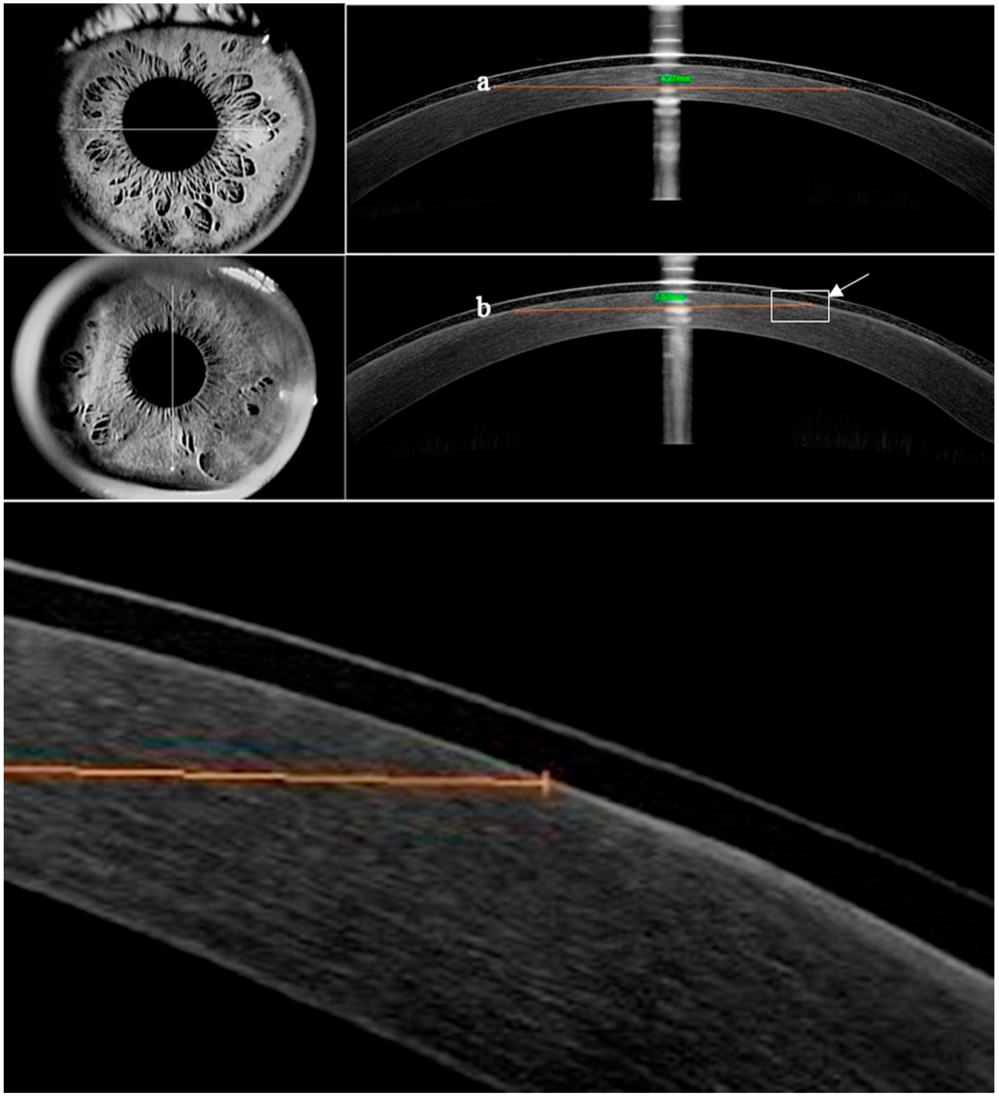 A Randomized, Double-Blind, Contralateral Eye Study Comparing the ...